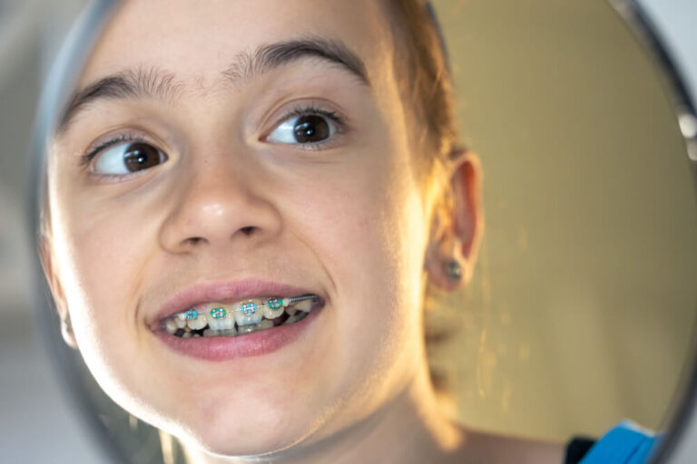 What is Crossbite? Signs, Effects, and Treatment - Walsh Dental